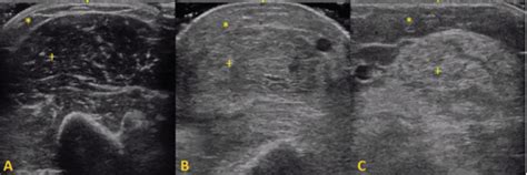 Muscle Ultrasound In Inflammatory Myopathies A Critical Review