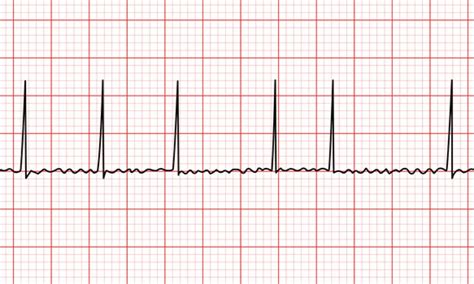 Atrial Flutter Ecg Introduction To Atrial Flutter On The Ecg For New