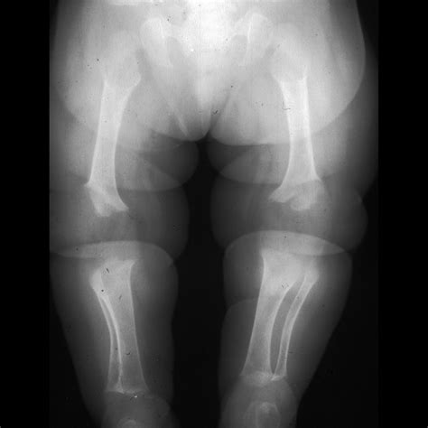 Metaphyseal Widening Pacs