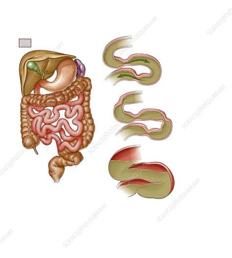 Irritable Bowel Syndrome Illustration Stock Image C0593532