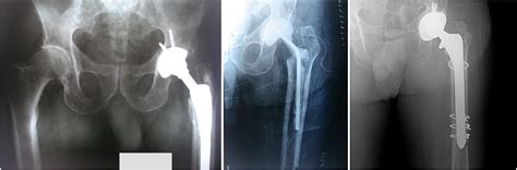 Two Stage Cementless Revision Total Hip Arthroplasty For Infected Primary Hip Arthroplasties