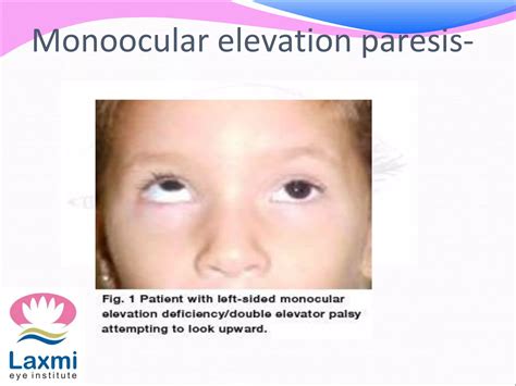 Gaze Palsy Pptx