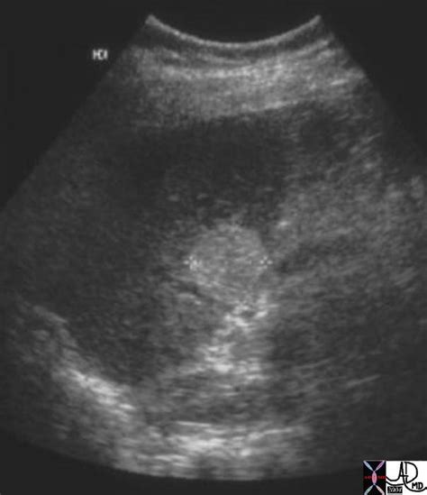Spleen Echogenic Ultrasound The Common Vein