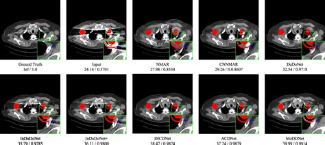 Figure 1 From Coupling Model And Data Driven Networks For Ct Metal Artifact Reduction