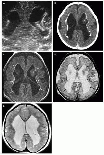 Cmv Periventricular Calcification
