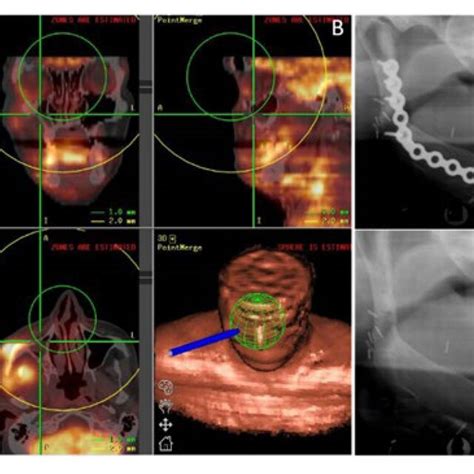 Fifty Seven Year Old Male Patient With Oral Cavity Squamous Cell Download Scientific Diagram
