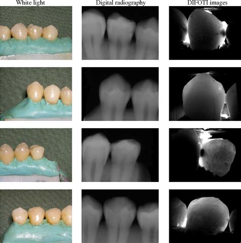 Figure 5 From Observer Reliability In Approximal Caries Detection Using