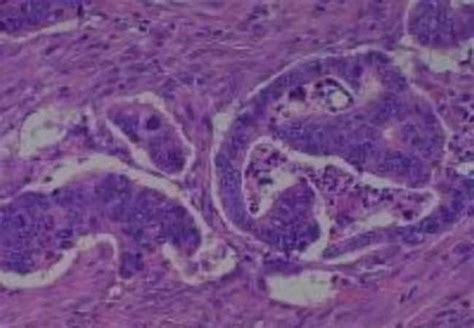 Novus Biologicals Human Multi Tissue Tissue Microarray Cancer Human