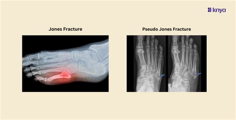 Learn The Difference Between Jones And Pseudo Jones Fracture Knya