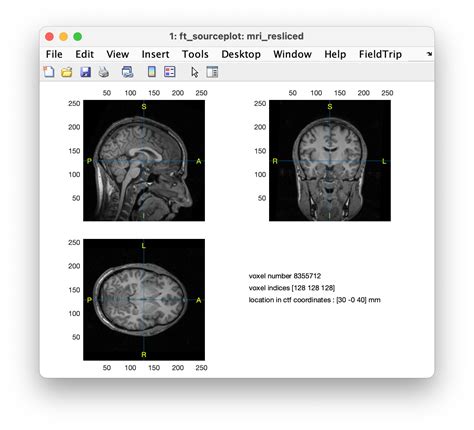 Creating A Bem Volume Conduction Model Of The Head For Source Reconstruction Of Eeg Data