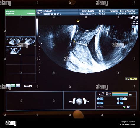 Dilated Cervix Ultrasound