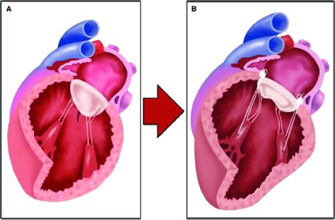 A Functional Impact Of Left Ventricular Remodelling On Mitral Valve Download Scientific