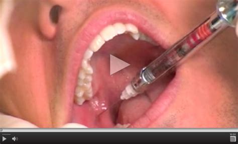 Nerve Block Mandibular Nerve Block Technique Nerve Block Mandibular