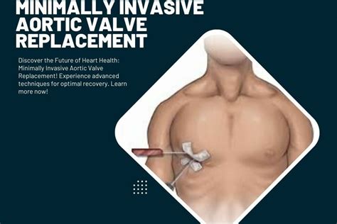 Minimally Invasive Aortic Valve Replacement Micsheart