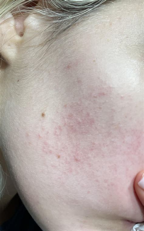 Sunscreen And Dermatitis Rdermatologyquestions