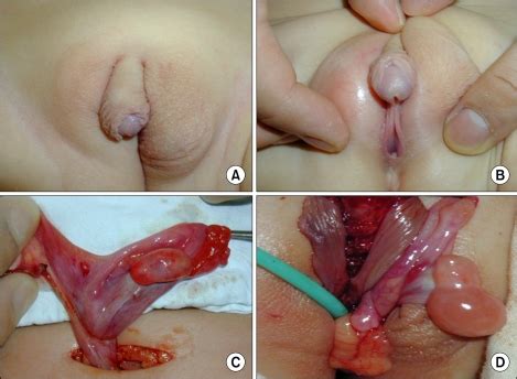 Medical Photographs Of Patients Suggestive Of XX Disorders Of Sex Download Scientific