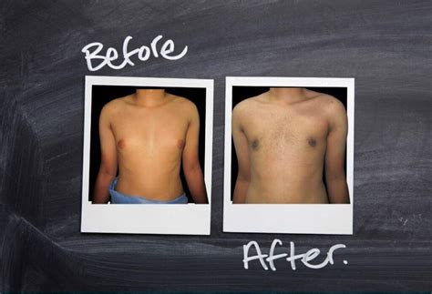 Best Gynecomastia Treatment In Kerala Safe And Affordable
