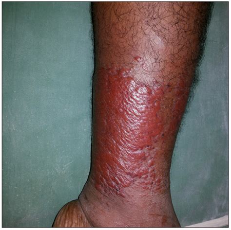 Mimickers Of Erysipelas And Cellulitis A Narrative Review Indian