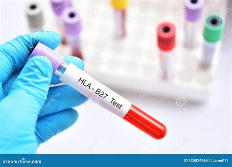 Blood Sample Tube For HLA B Test Stock Photo Image Of Arthritis Hospital
