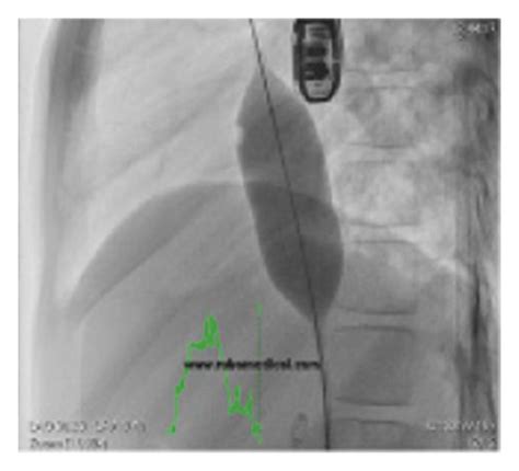 A B Ivc Angiogram In Frontal And Lateral Views Demonstrates The