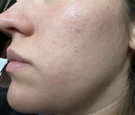 Congested Skinredness Ive Have Congestedtextured Skin And Need Suggestions For A Skin