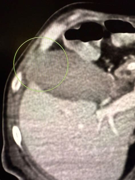 The Tensile Gallbladder Fundus Sign Is A Ct Finding That Suggests Severe Sameer Raniga