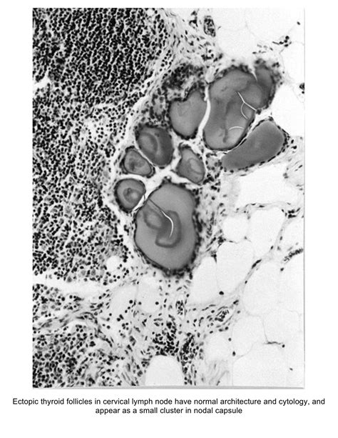 Pathology Outlines Thyroid Inclusions