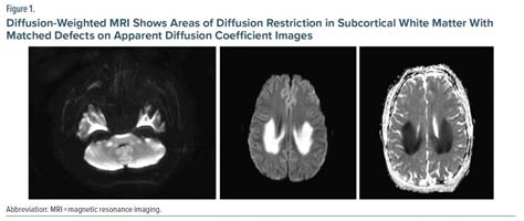 Leukoencephalopathy After Excessive Cannabinoid Use
