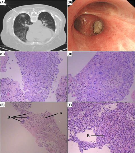 Computed Tomography‐guided Percutaneous Needle Biopsy Of A Lung Lesion Download Scientific