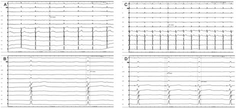 Feasibility Safety And Effectiveness Of Mapping System Assisted Conduction System Pacing A