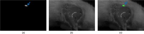 sentinel lymph node sln mapping using new fluorescence goggle system