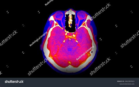 Ct Brain Perfusion Ct Scan Image Stock Illustration 2412307613 Shutterstock