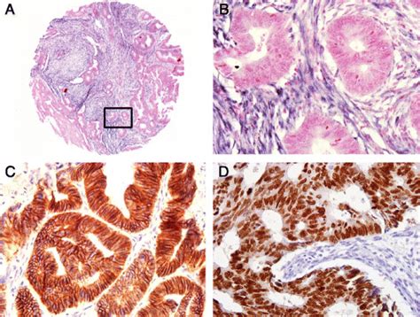 In Situ Hybridization For Mir 21 And Immunohistochemistry For
