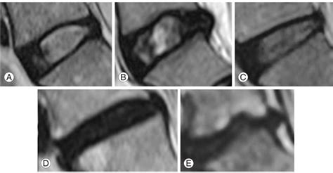 Lumbosacral Transition Vertebra Prevalence And Its Significance Pmc