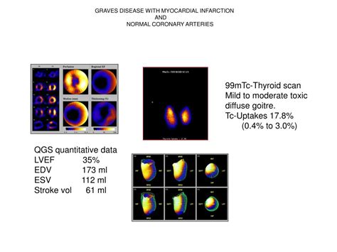 Ppt Stress Rest Mpi Fixed Perfusion Defect In Distal Antero Septal Region Apex And Distal