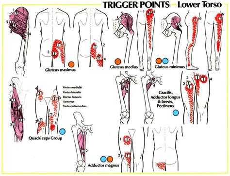 Sartorius Trigger Points Sartorius Trigger Points