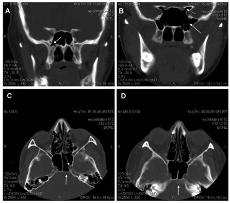 Greater Wing Of Sphenoid Radiograph