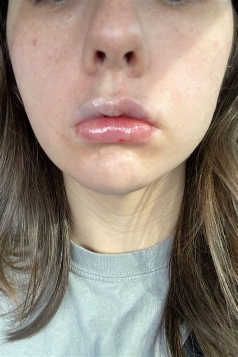 Why Are My Lips White After Filler
