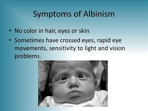 Ppt Albinism And Vitilago Powerpoint Presentation Free Download Id