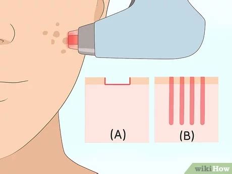 How To Remove Pimple Scars Fast