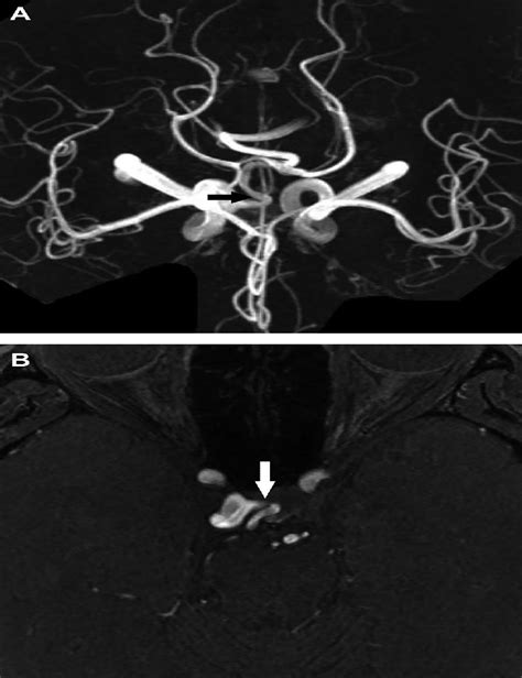 Successful Microvascular Decompression For Trigeminal Neural Operative Neurosurgery