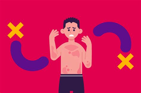 Eritema Multiformis Gejala Penyebab Dan Pengobatan