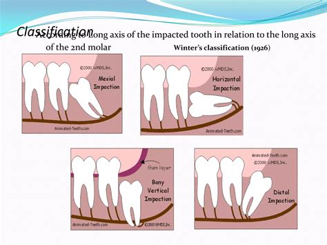Mandibular 3rd Molar Impactions Pptx