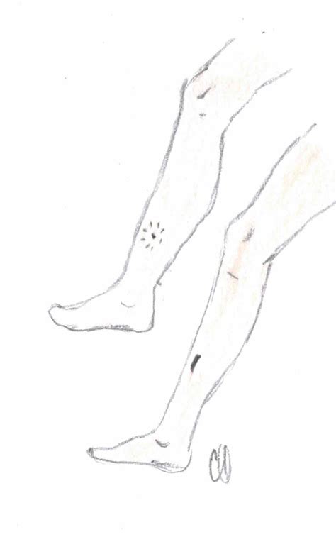 Open Fractures Gustilo Anderson Classification