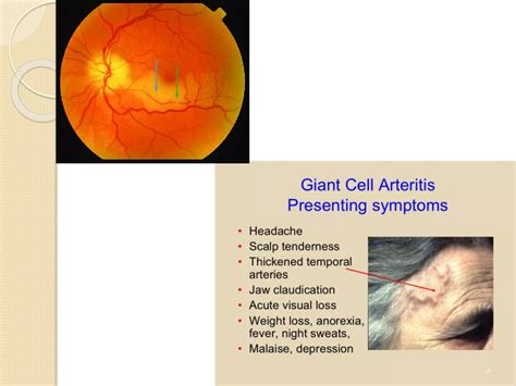 Optic Nerve Disease Pptx