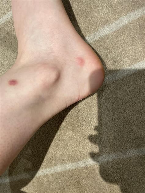 Skin Turning Purple After Bug Bites R Brazil