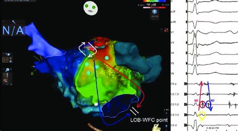 Activation Mapping Shows The Re Entry Circuit At The Anteroseptal Left Download Scientific
