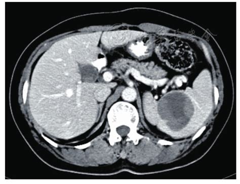 外囊ct图片t图片t图片大山谷图库