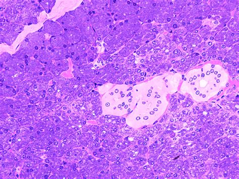 Parotid Gland