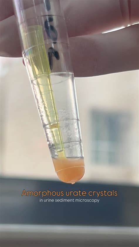 Xətayə M Quliyeva Microbiologist Md Amorphous Urate Crystals In Urine Sediment Microscopy